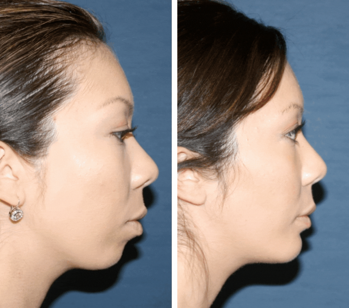 Genioplasty Chin Surgery Stephen P Beals Md